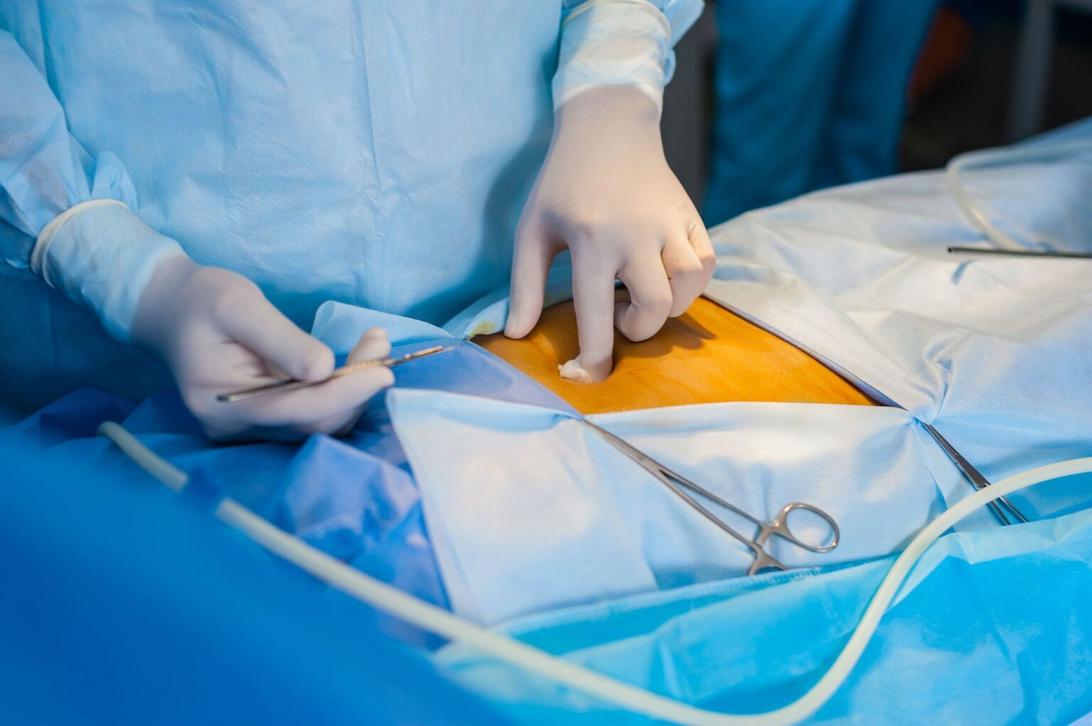 Todo sobre la hernia inguinal: ¿Qué es? ¿Cómo se detecta? ¿Cuál es el ...